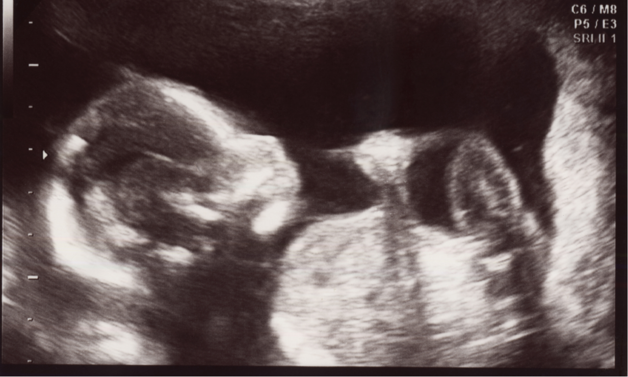 Scan Detail Bayi - Klinik Uzma