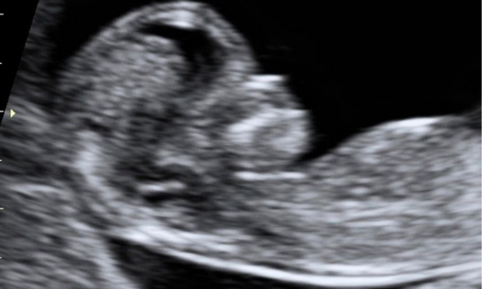 Scan Nuchal Translucency (NT) - Klinik Uzma